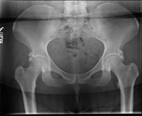 Hip Arthroscopy Knee And Sports Orthobullets