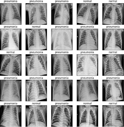 Figure 1 From Classification Of Chest X Ray Images Pneumonia Based On Resnet And Grad Cam