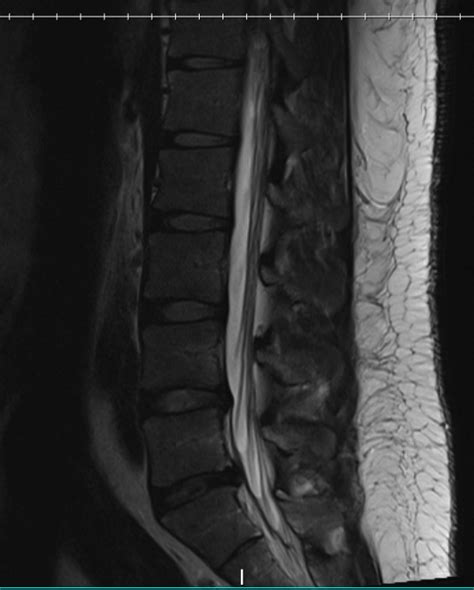 Mri Injection Options Or Surgey R Sciatica