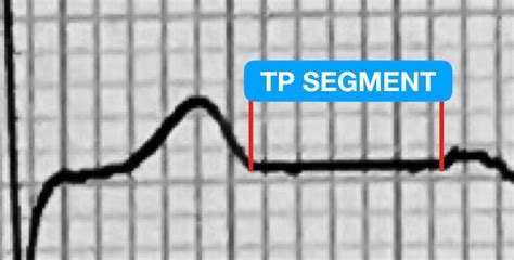 Ecg Segments And Intervals — The Pr