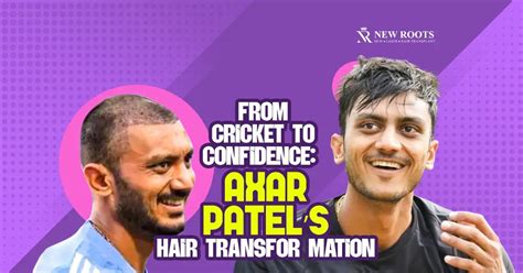 Axar Patel Hair Transplant Journey From Pitch To Perfection