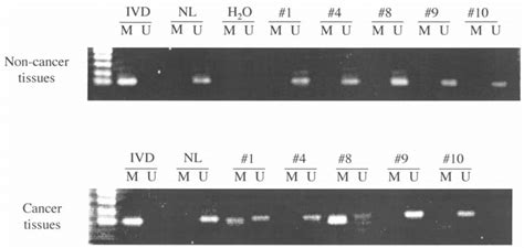 an msp analysis of the runx3 gene using 5 paired cancer and