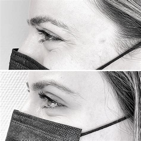 Botox Kraaienpootjes Kliniek Vinci
