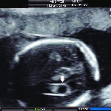 A Single Sonolucent Choroid Plexus Cyst In The Far Lateral Ventricle