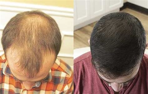 No Shave Fue Hair Transplant Near Fairhope Your Solution For Hair Loss