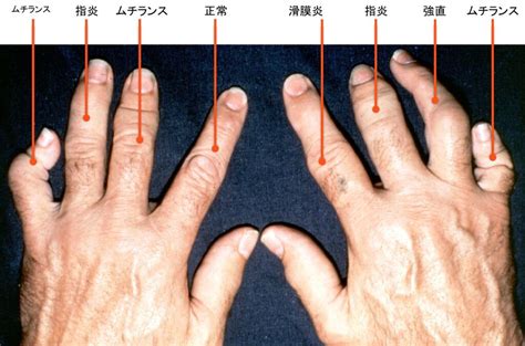 乾癬性関節炎（乾癬に関連する関節炎）について 豊田土橋リウマチクリニック｜愛知県の関節リウマチ治療専門外来（専門医）｜名古屋から30分