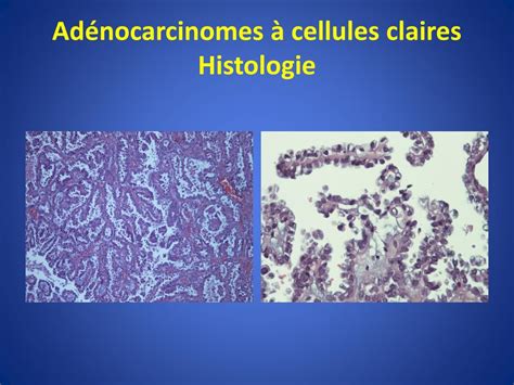 PPT Classification histologique voies de cancérogénèse PowerPoint Presentation ID 4750363