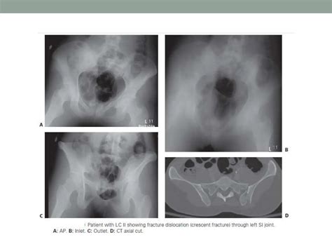 Pelvic Fractures Pptx