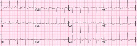 Dr Smiths Ecg Blog St Elevation In Lead Avr With Diffuse St