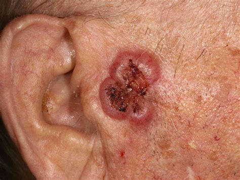Squamous Cell Cancer Symptoms