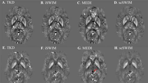 Multi Echo Quantitative Susceptibility Mapping For Strategically Acquired Gradient Echo Stage