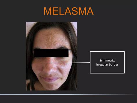Overview Of Hyperpigmentation Disorders Pptx