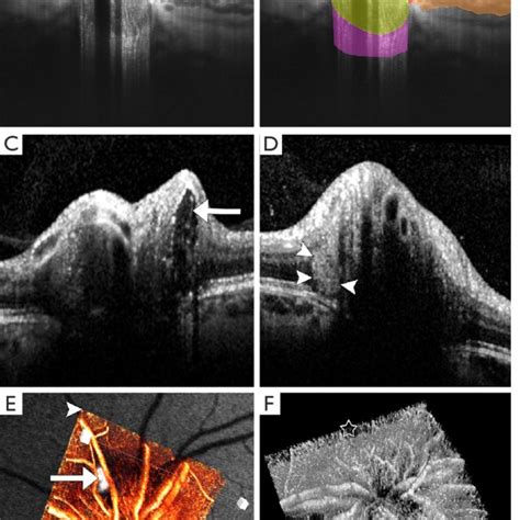 Oct Imaging Of A Normal Optic Disc And In A Case With Superficial Odd
