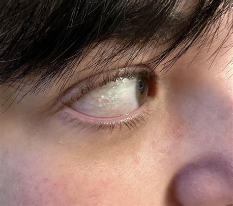 Weird Bumpy Things Rsarcoidosis