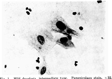 Figure 1 From Cytological Diagnosis In Dysplasia Of The Uterine Cervix