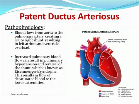 Patent Ductus Arteriosus Pathophysiology