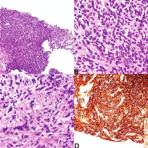 Histologic Features Of Interdigitating Dendritic Cell Sarcoma