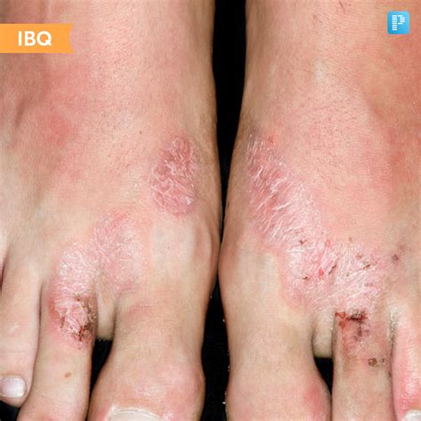 A 23 Year Old Female Presents With An Prepladder Medical