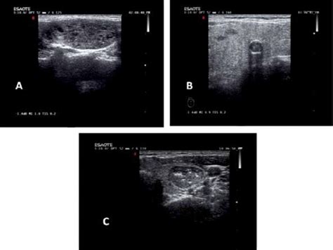 Thyroid Nodule Calcifications Detected In Ultrasonography A