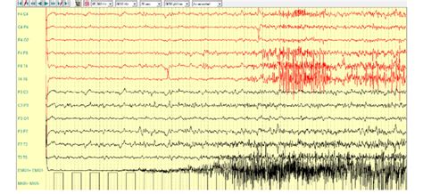 Electroencephalogram Eeg And Electromyography Emg Recording