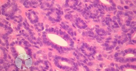 Polymorphous Sweat Gland Carcinoma Pathology Image