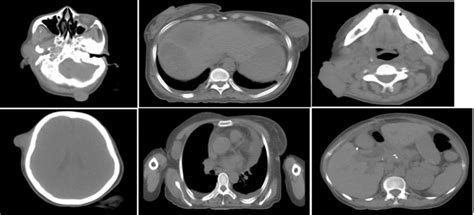 Ncct Head Thorax And Abdomen Showing Scalp Metastasis Breast