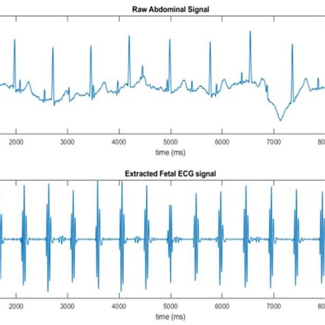 Representing The Raw Abdominal Signal The Finally Obtained Fetal ECG