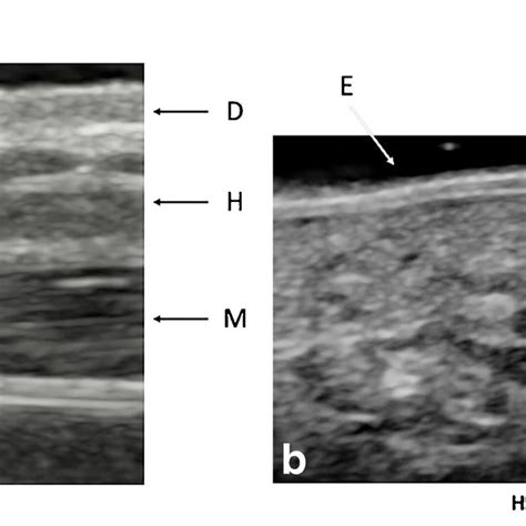 Normal Skin Histology Histology Shows Epidermis E Dermis D And