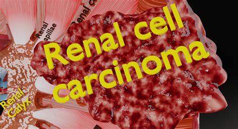 Renal Cell Carcinoma 3d Model Superhive Formerly Blender Market