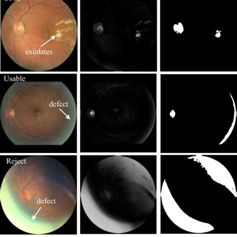 Examples For Detecting Large Size Salient Structures From Retinal