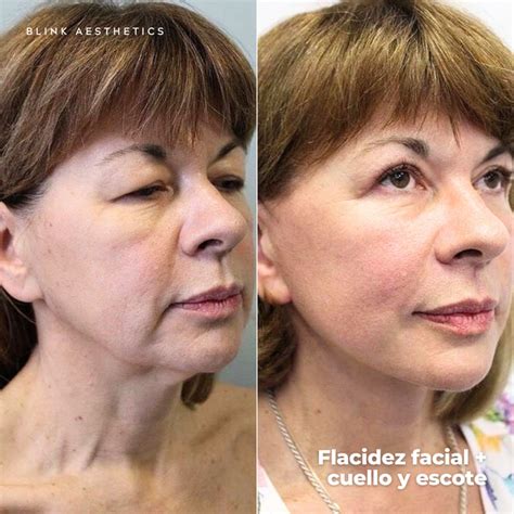 Ultrasonic 9d · Lifting Facial Centros Blink