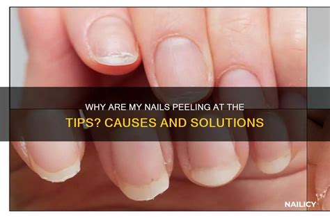 Why Are My Nails Peeling At The Tips Causes And Solutions Nailicy