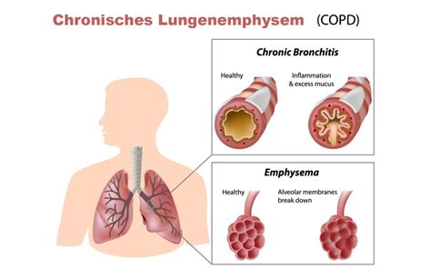 Chronisches Lungenemphysem Symptome Ursachen Und Therapie Der COPD