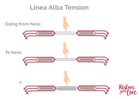 Diastasis Recti Pregnancy