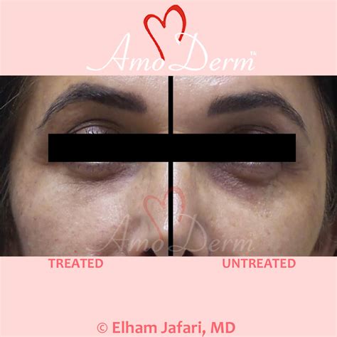 Treat Dark Circles And Bags Under Eyes Using Fillers And Lasers