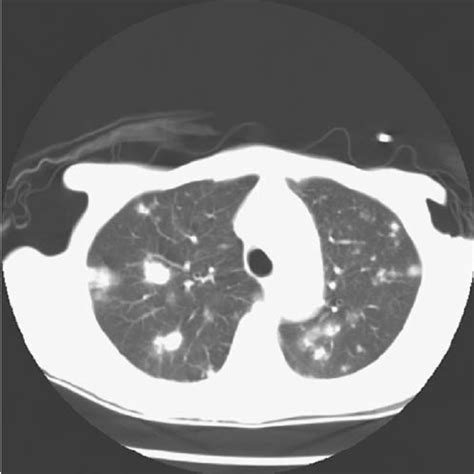 Posteroanterior View Of The Chest Patchy Nodular Densities In Both Download Scientific Diagram