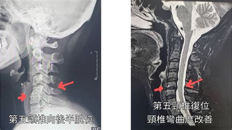 偏頭痛、血壓高？可能是你的頸椎出問題囉！