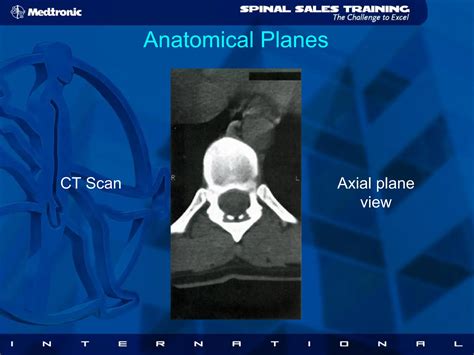 Medtronic Basics Of Spinal Anatomy Of Human Pdf