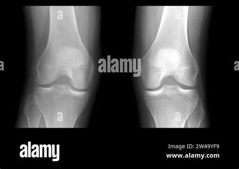 Stop Motion Of Body Parts Ct Or X Ray Scan Collection Human Hands