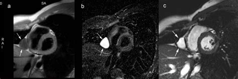 Congenital Pericardial Cyst T1 Weighted Spin Echo Cmr A T2 Weighted
