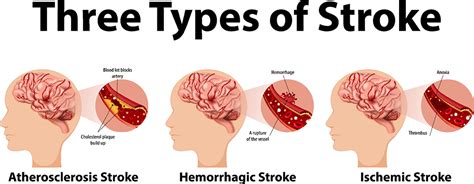 Stroke Holistic Caring