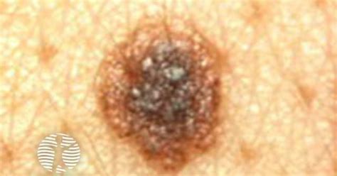 Dermnet® Globular Pattern Clinical Image