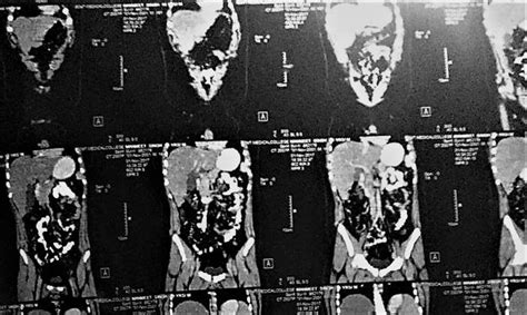 Ct Scan Of Abdomen Showing Swollen Appendage In The Subhepatic Region