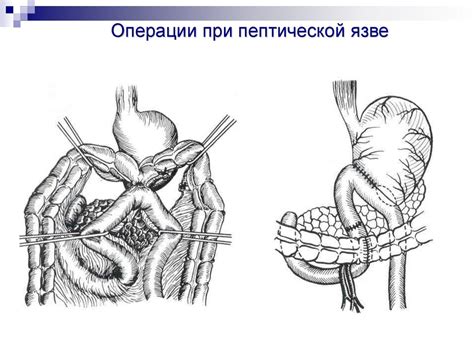 Болезни оперированного желудка презентация онлайн