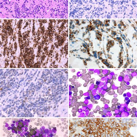Figure1radiological Findings Of Myeloid Sarcoma Of The Thoracic Spine