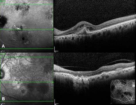 Baseline Images Showing Polyps In Icga A With Corresponding Sd Oct Download Scientific