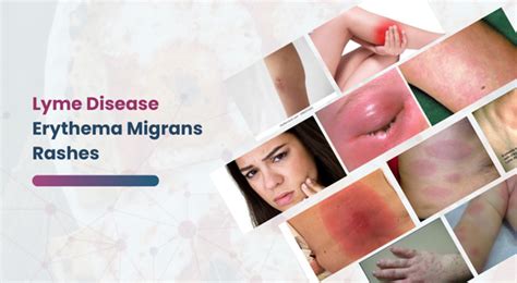 Lyme Disease Erythema Migrans Rashes Dataset For AI Medical