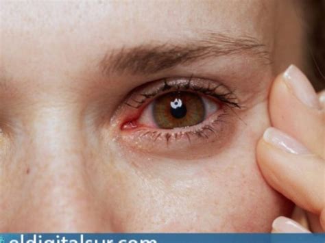 Por qué se hinchan los ojos al llorar 10 causas y soluciones