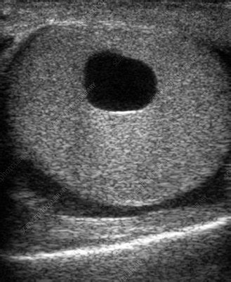 Testicular Cyst Ultrasound Scan Stock Image M Science Photo Library