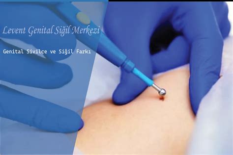 Genital Sivilce ve Siğil Farkı